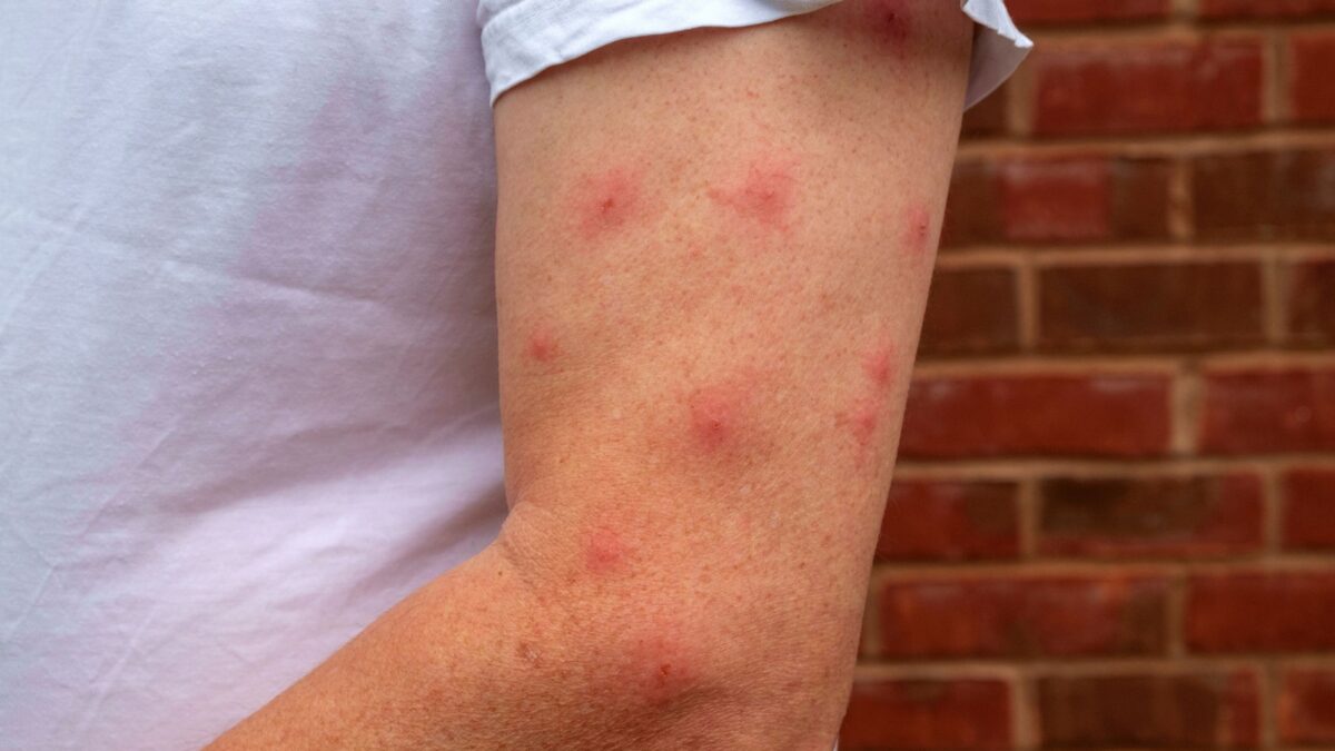 Are Bug Bites Dangerous? How to Tell What Bit You - Insight Pest Control